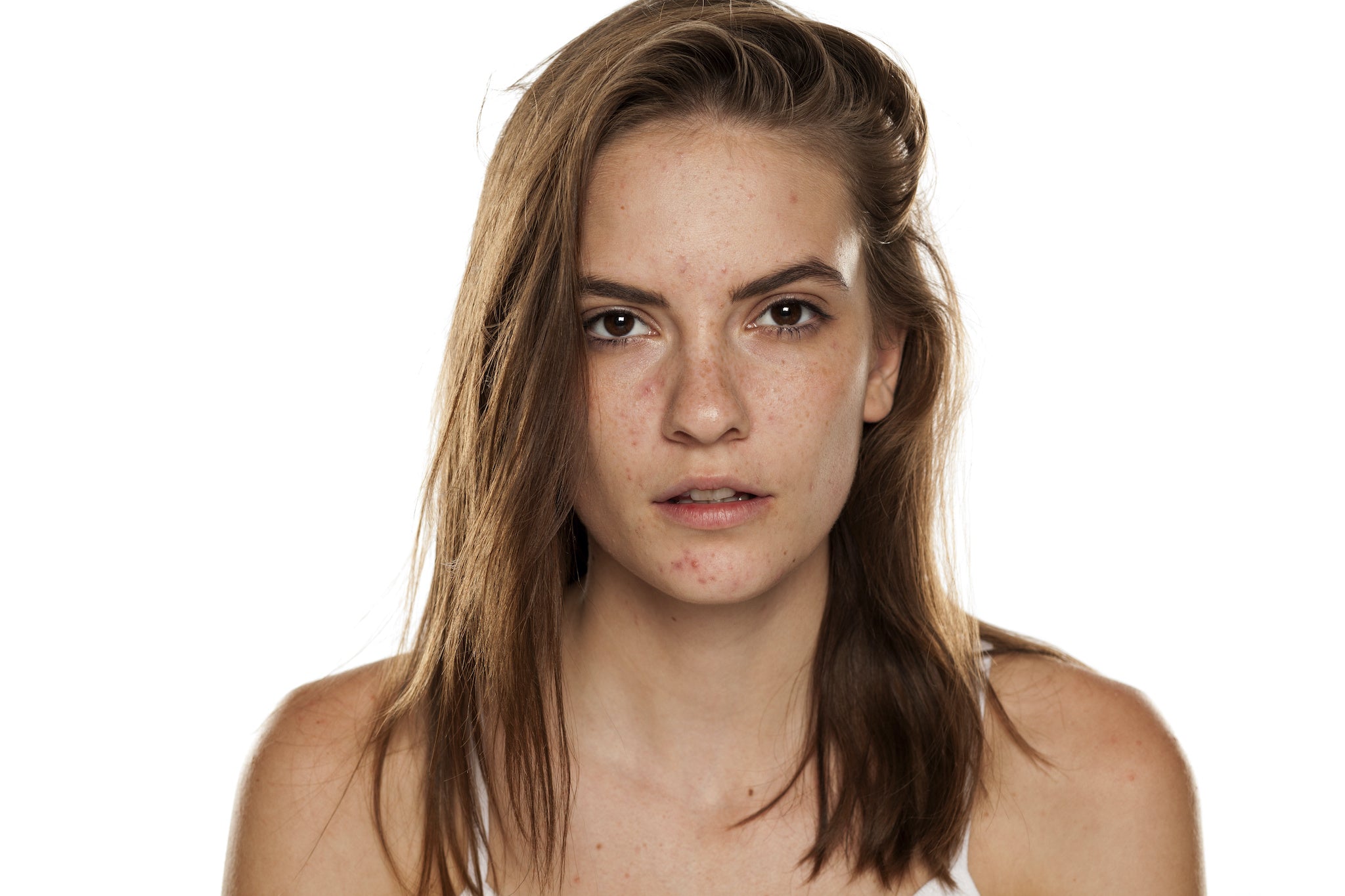 Common Causes Of Adult Acne And How You Can Avoid It Teenology
