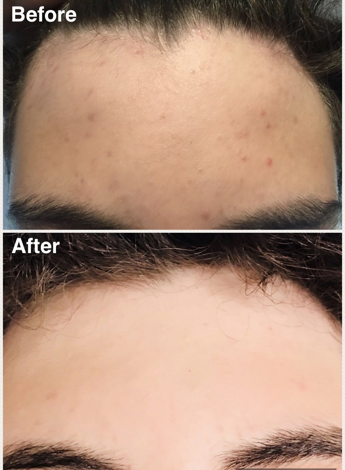 Avoid Pomade Acne and Scalp Acne With TEENOLOGY